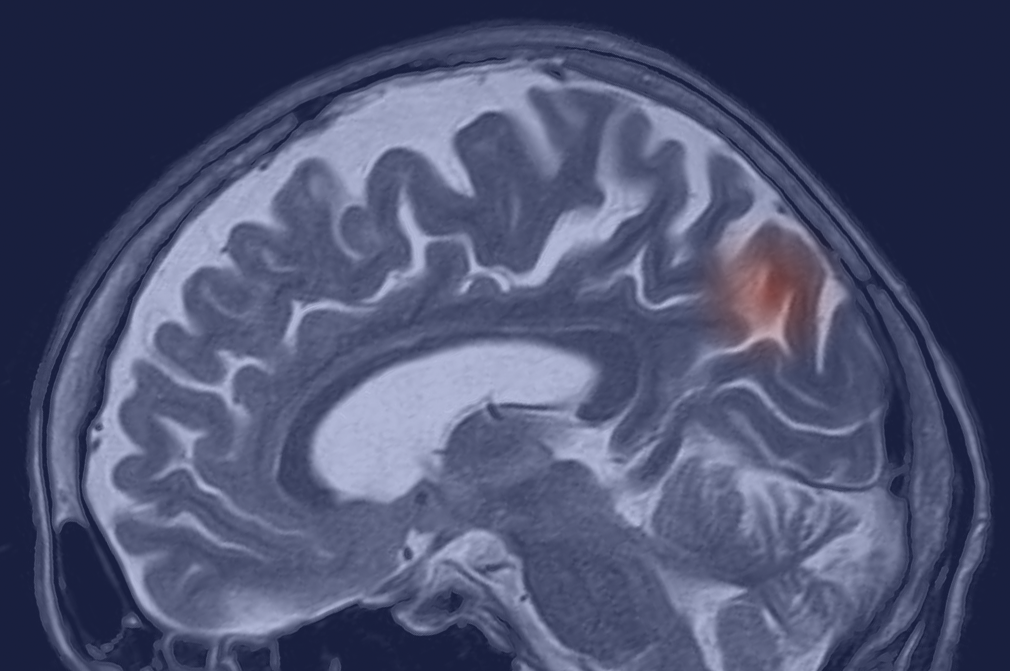 Stroke Toolkits – Colorado Stroke Advisory Board